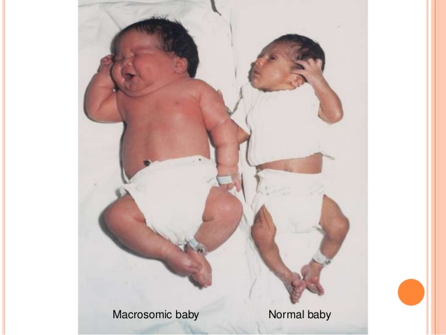 Gestational Diabetes Gestational Diabetes
